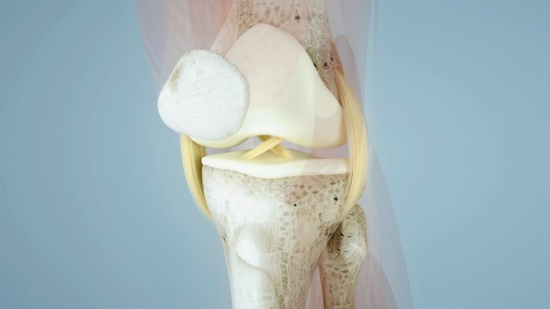 Patologia Femoro Rotulea